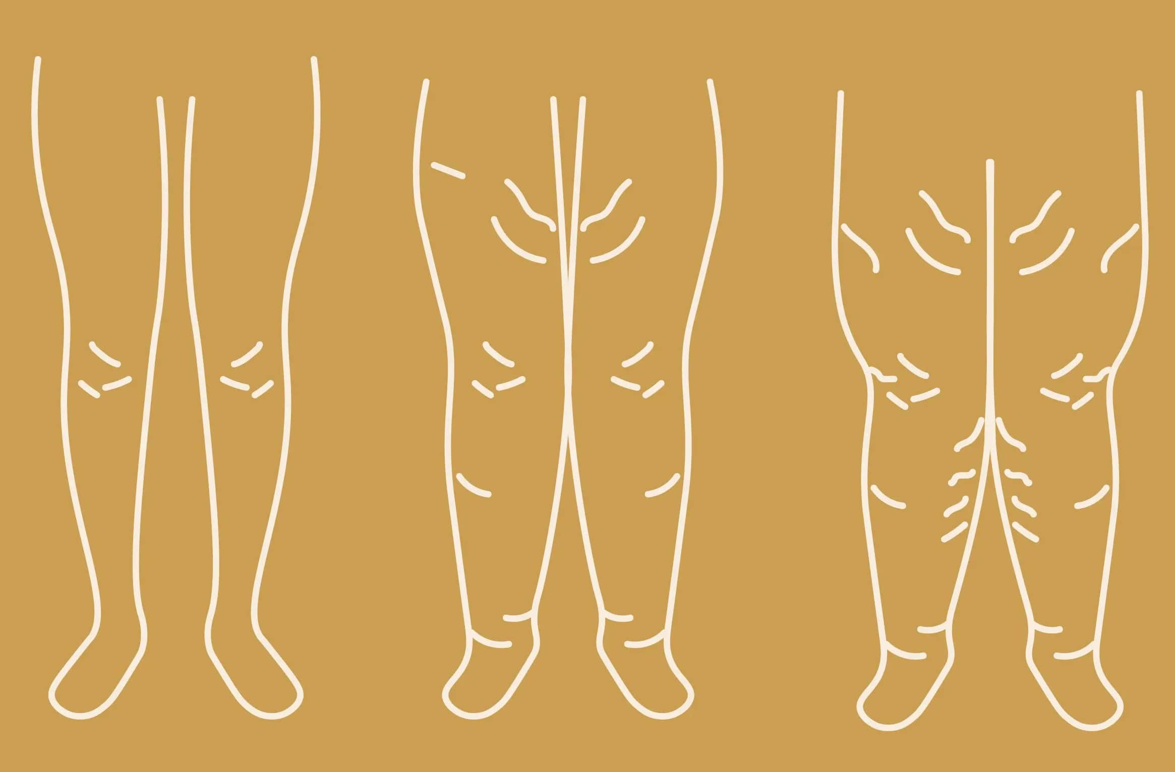 Lipedema – when fatty tissue starts to hurt - IMC Priora